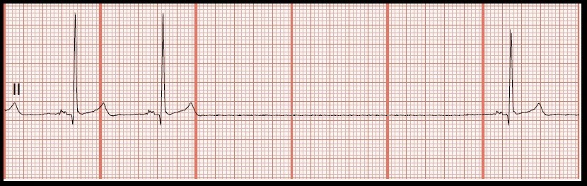 Various Sinus Arrests and Sinus Pauses