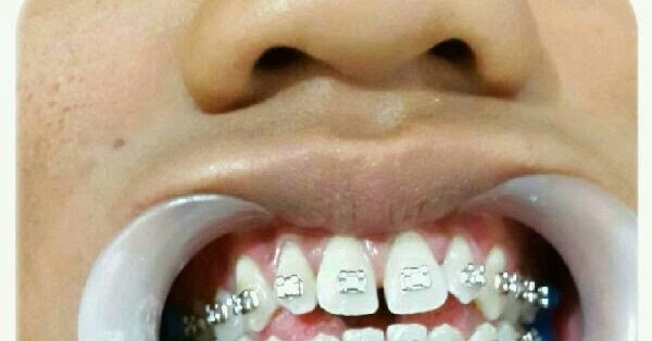 DOKTER GIGI BALI: Pengen Punya Gigi Rapi Dan Ganteng Alasan Pria ini ...