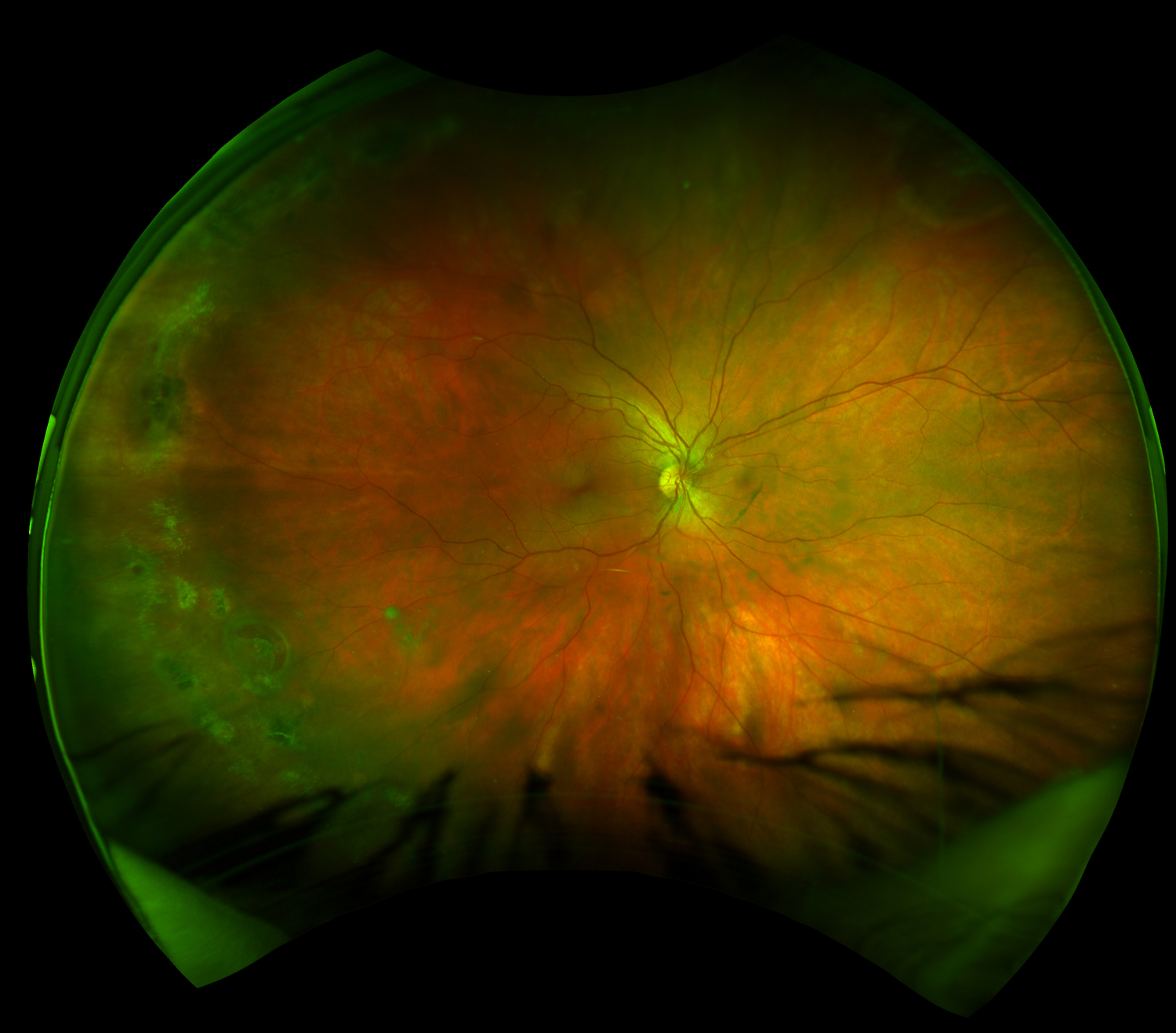 What The Fundus? New Website for Sharing Optos Retinal Images - Eyedolatry