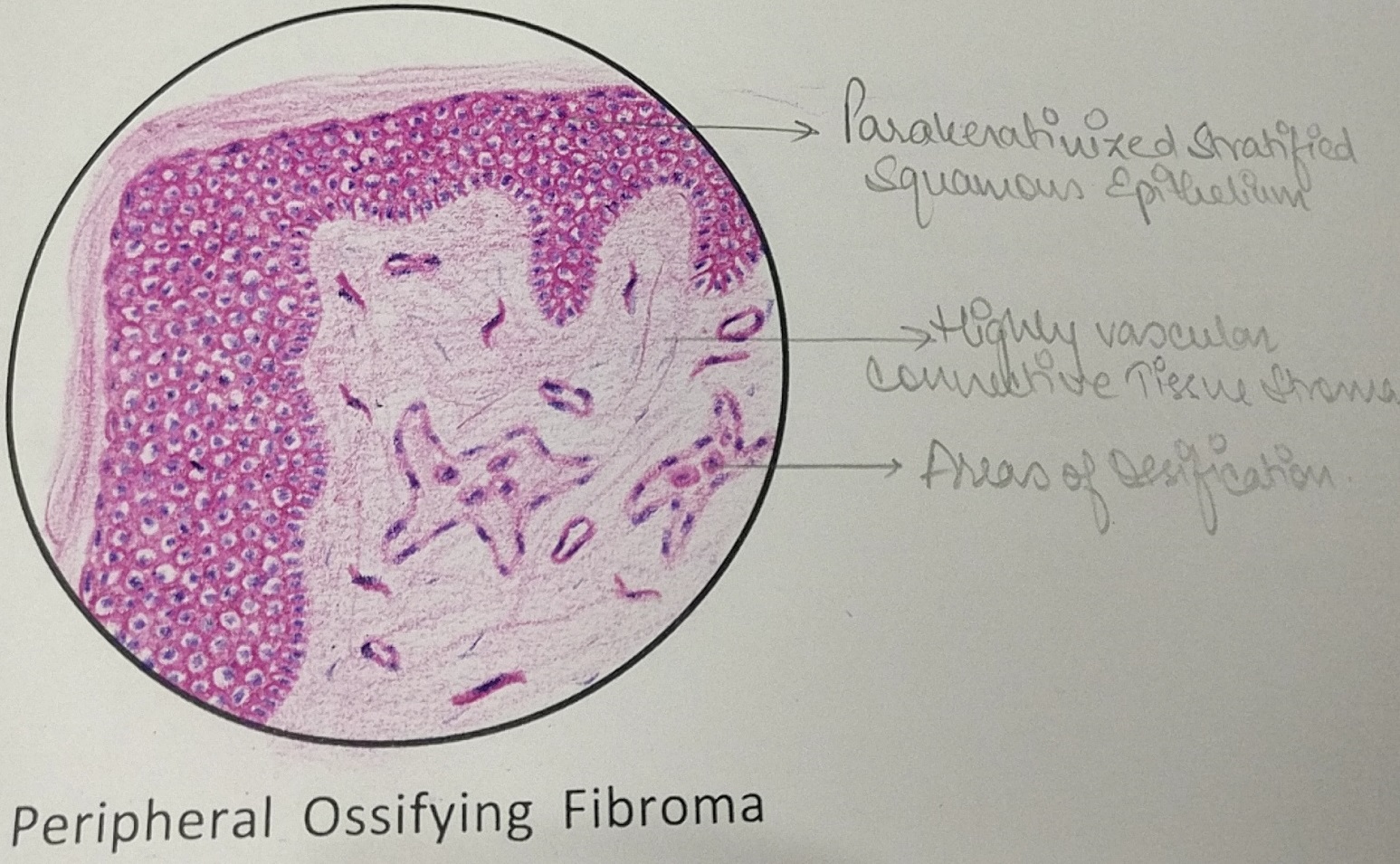 Peripheral Ossifying Fibroma Histology