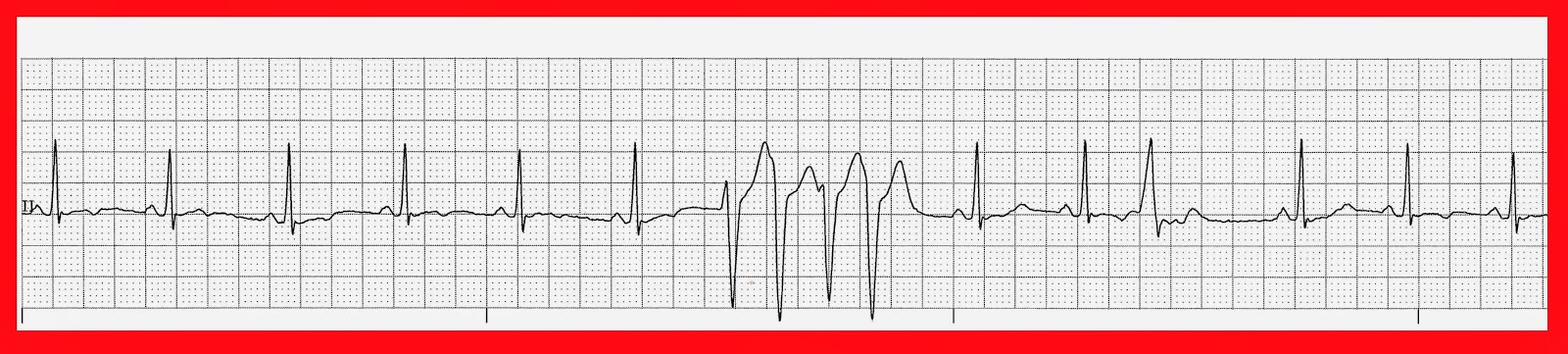 EKG Rhythm Quiz 254