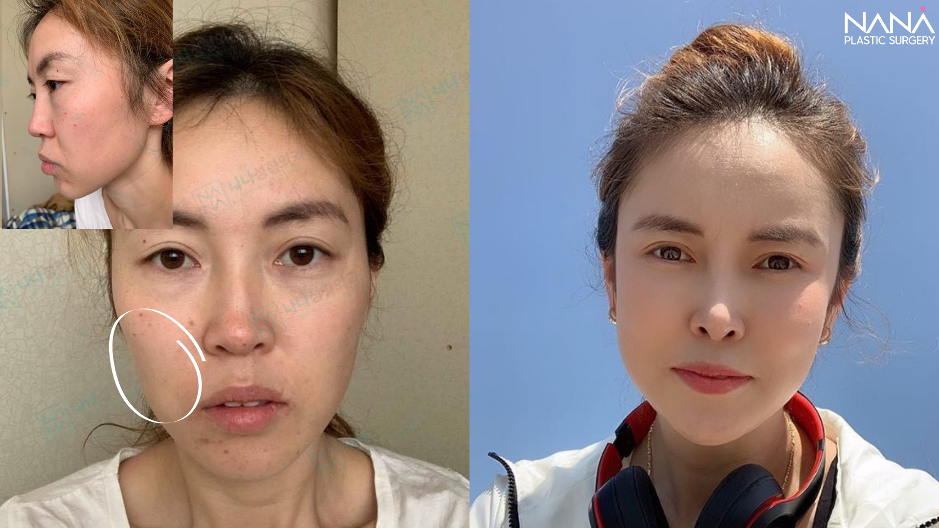 [ FACIAL FAT GRAFTING ] WAY TO LOOK YOUTHFUL AND FRESH | HOW IS THE ...