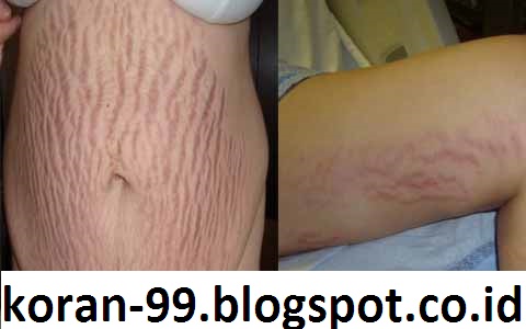 DIBACA DONG : Sikat Habis Stretchmark Di Perutmu Hanya Dengan 7 Bahan ...
