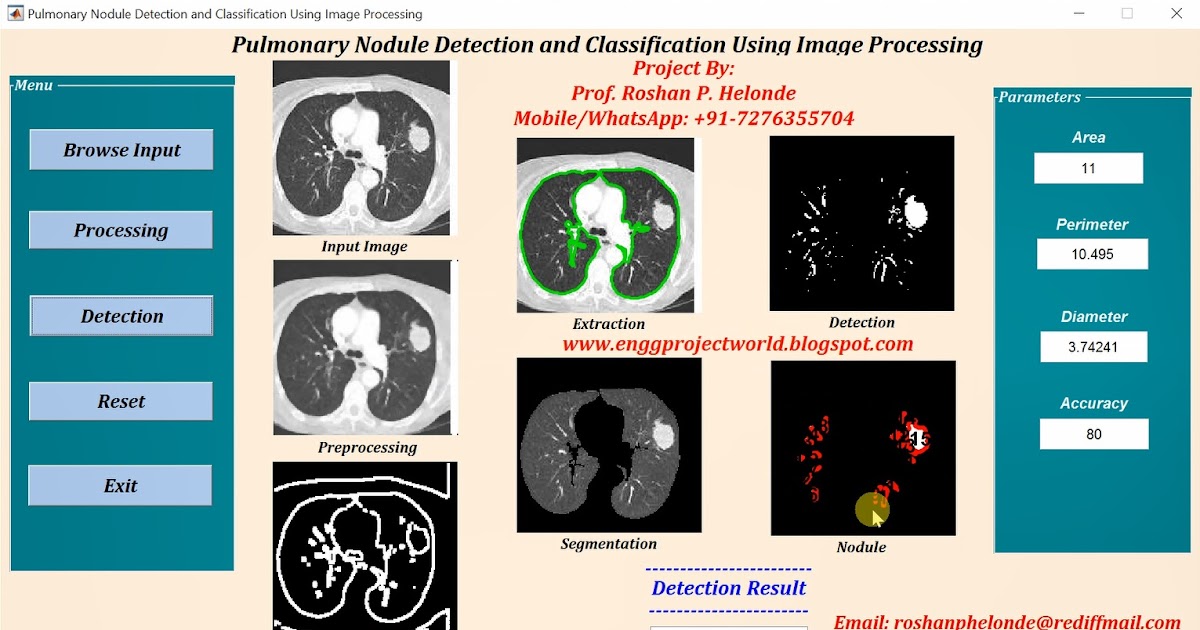 Lung Nodule Detection Using Image Processing Matlab Project With Source