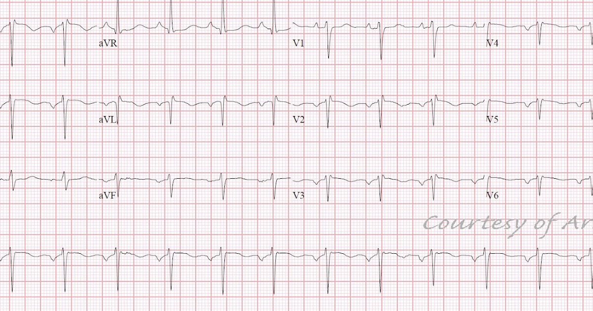 ECG Rhythms: Ectopic Atrial Rhythm in Dextrocardia