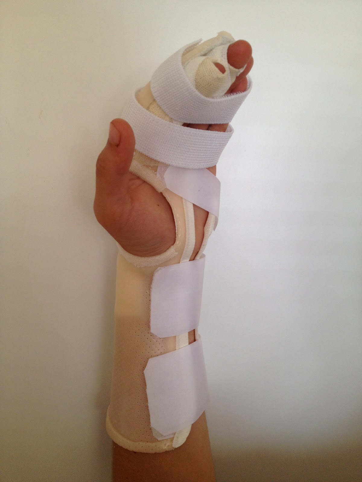 Orthèses sur mesure et appareillage personnalisé main poignet doigts ...