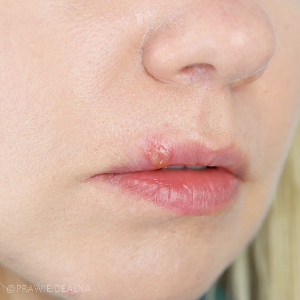 Opryszczka - co to jest i jak się jej pozbyć