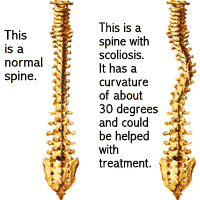 Become a Homeopathy expert: CURVATURE SPINE Caries