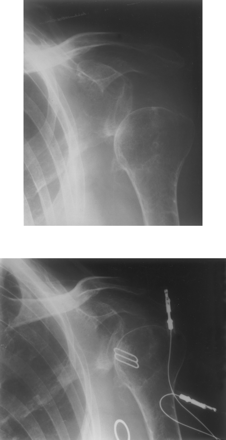 The Role of NMES in the Rehabilitation of the Upper Limb Post Stroke ...