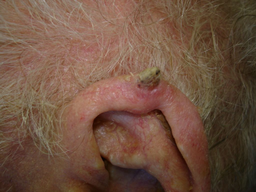 Dermatology For Dentists and Dental Students: Ears