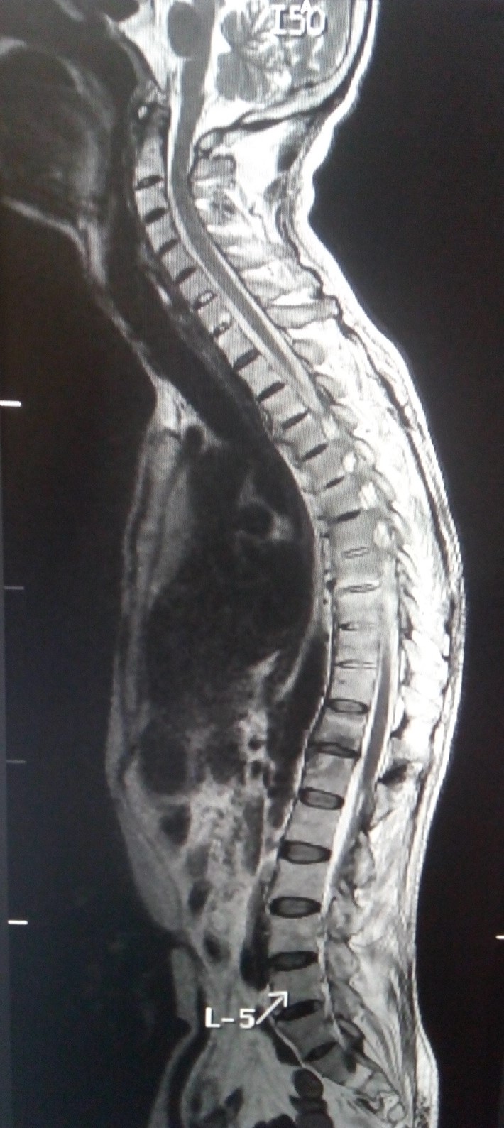 Ankylosing Spondylitis: MRI - Sumer's Radiology Blog