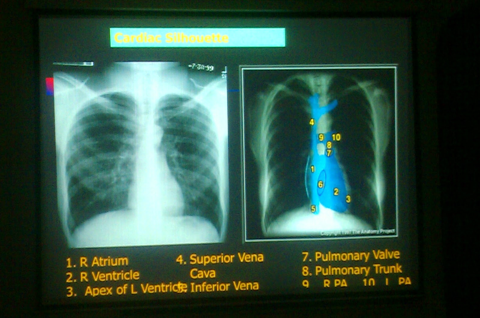 Lecture slides: Radiology: Chest X ray