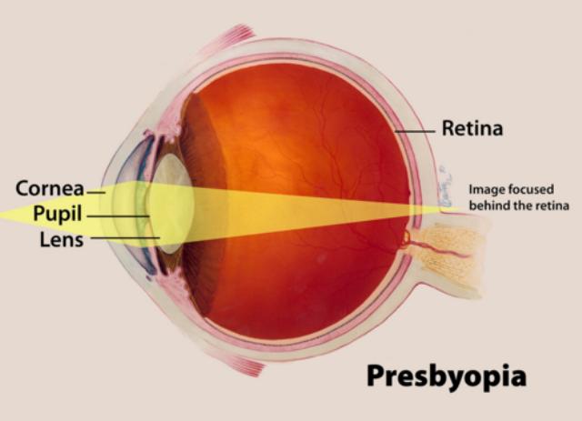 Pencegahan Mata Presbiopia Secara Alami dan Aman - ritasfantasi