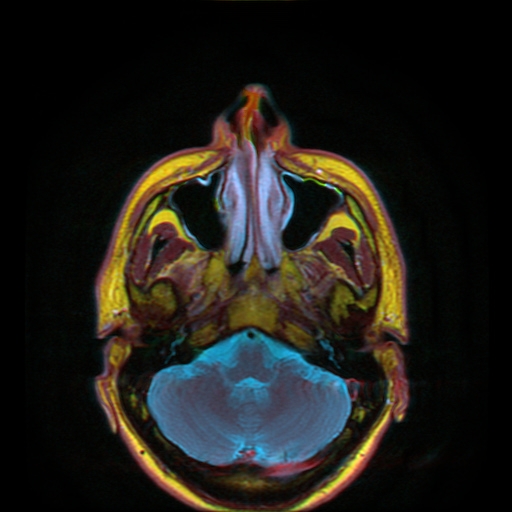 Nevit's blog: Color MRI of the Neck