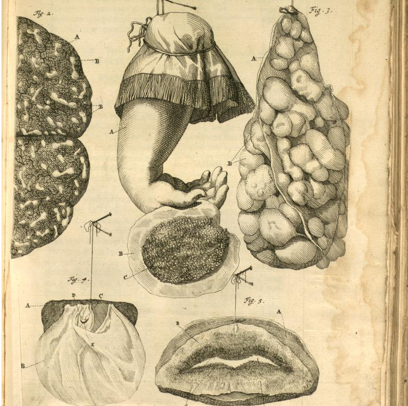 Sensualising Deformity: Grotesque Bodies