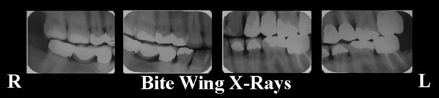 Staff's Diary: Bite-Wing X-ray：バイトウィング法（咬翼法）