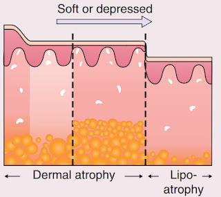 what is the difference between lipoatrophy and lipodystrophy?