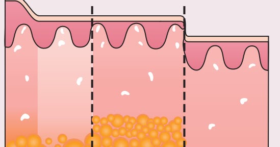 what is the difference between lipoatrophy and lipodystrophy?