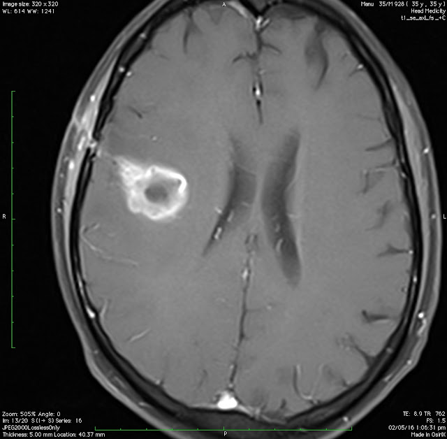 Ultimate Radiology : Frontal lobe abscess : follow up MRI