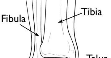 Fratura de Pilão tibial