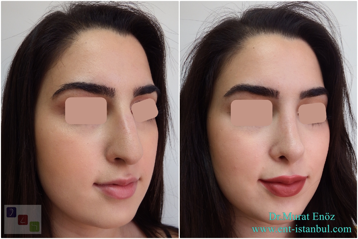 Health Zone Turkey: Nose Job in Istanbul, Turkey