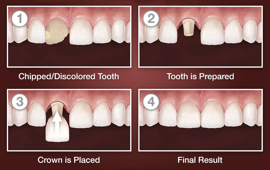 When Are Dental Crowns Necessary? ~ Dr. Bharat Katarmal Dental ...