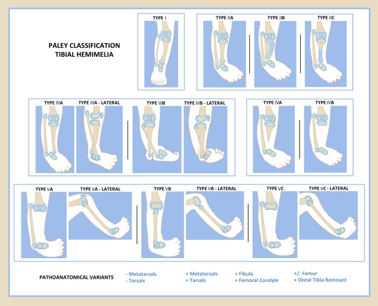 Tibial hemimelia - wrodzony brak kości piszczelowych