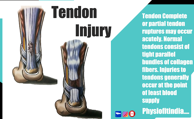 Tendon injury,most common tendon injury