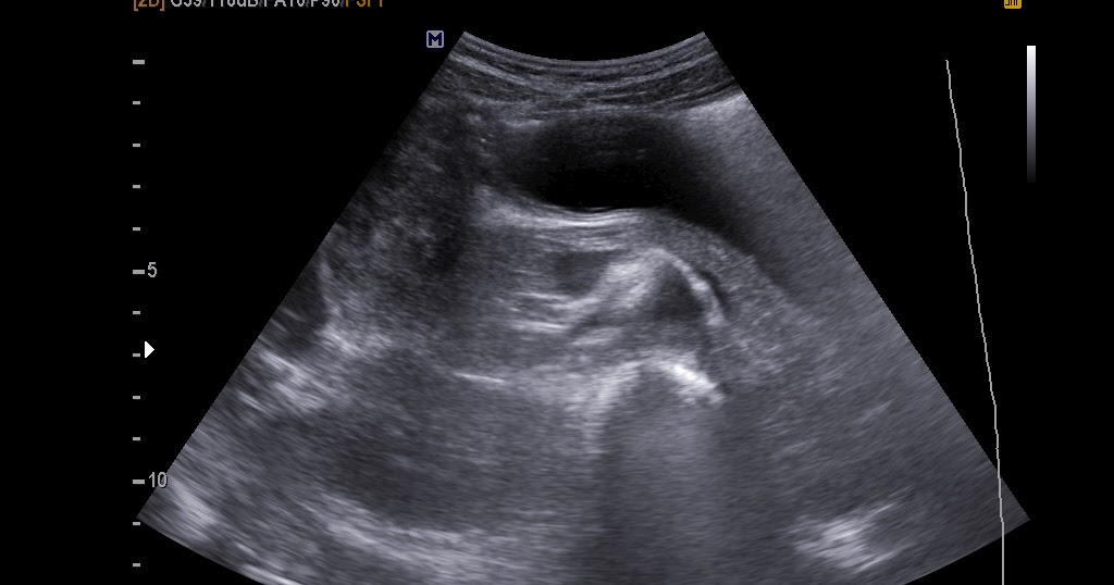 VIETNAMESE MEDIC ULTRASOUND: CASE 171: THICKENING OF ANTRUM WALL, Dr ...