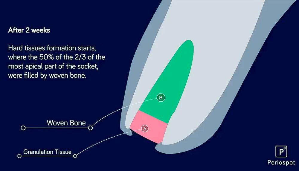 ORAL SURGERY: Bone Dynamics after extraction - Odonto-Tv