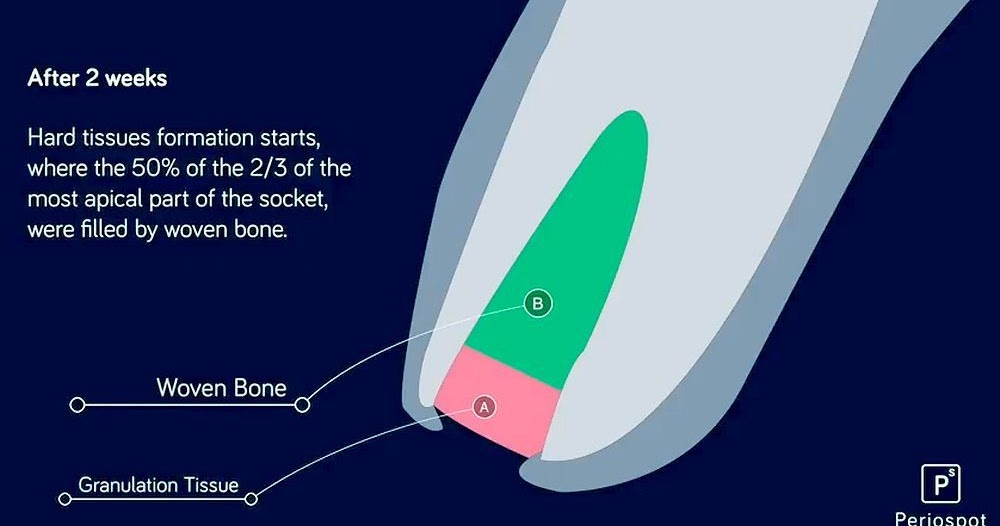 ORAL SURGERY: Bone Dynamics after extraction - Odonto-Tv