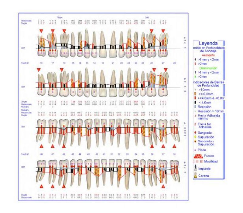 CASO CLÍNICO: Tratamiento de un paciente con Periodontitis Crónica ...