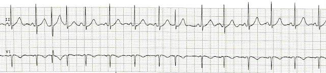 EKG Rhythm Strip Quiz 64