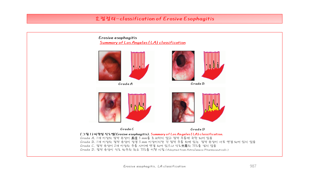 LA classification of Erosive Esophagitis-Practice Essentials (987)