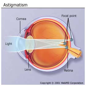 @INFOOPTIK.IDV: PENGERTIAN ASTIGMATISM (Mata Cylindris)