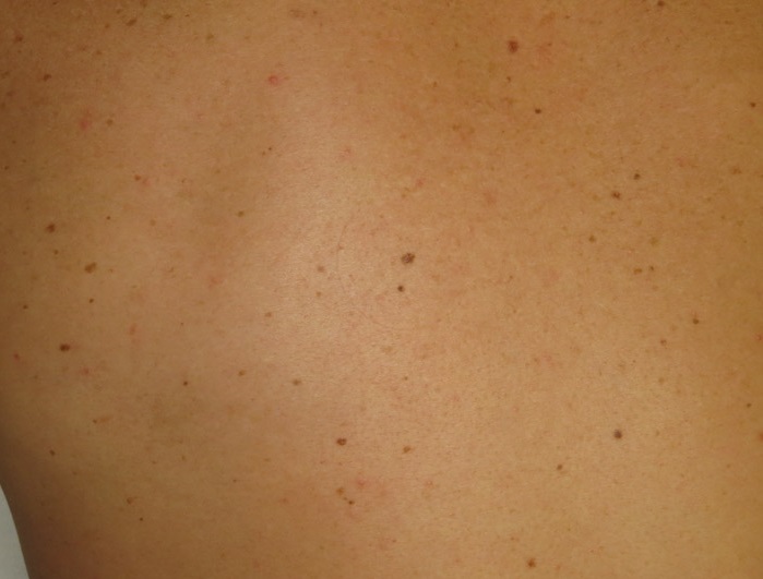 Photos of Moles on Chest and Back ~ How To Remove Moles, Warts, Skin ...