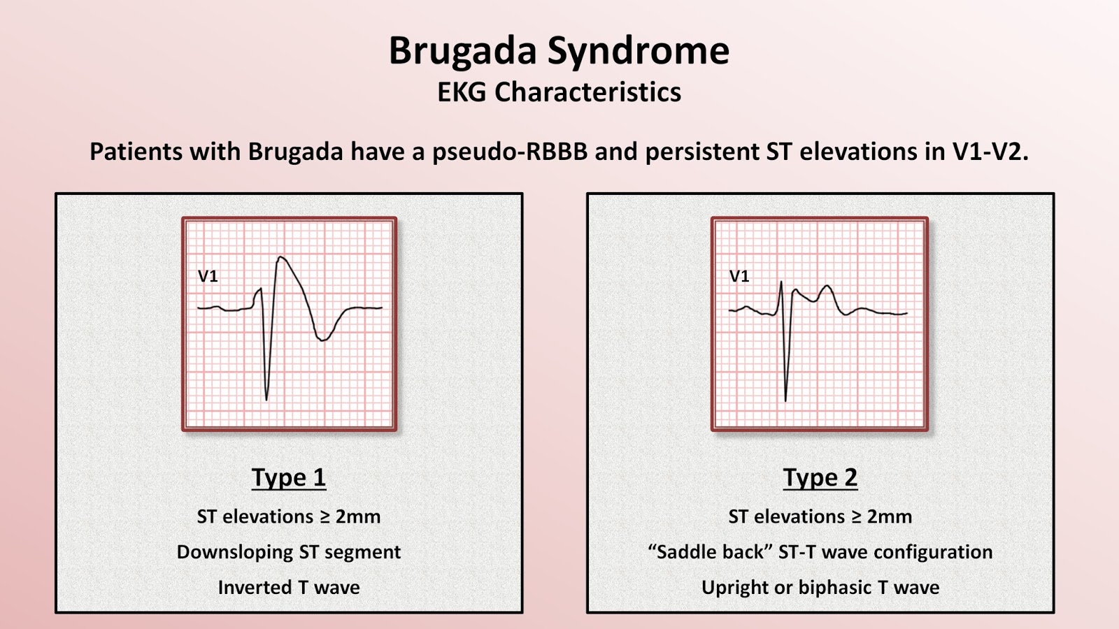 Cardiology MCQ 53: Brugada syndrome