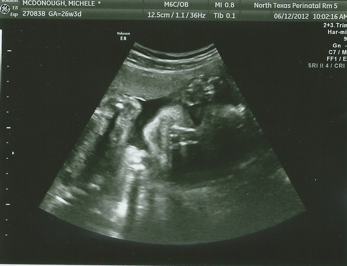 26 Weeks Ultrasound
