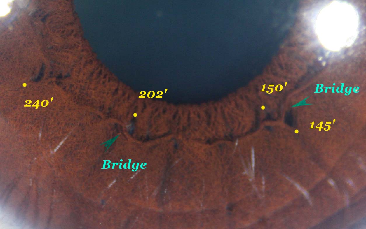 Modern & Multidimensional Iridology: Collarette Bridges, Angle of Fuch ...