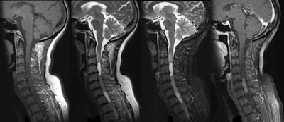 Roentgen Ray Reader: Grade II Spinal Cord Ependymomas