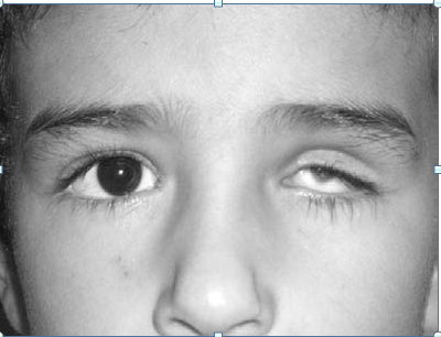 Microftalmia; Microftalmo