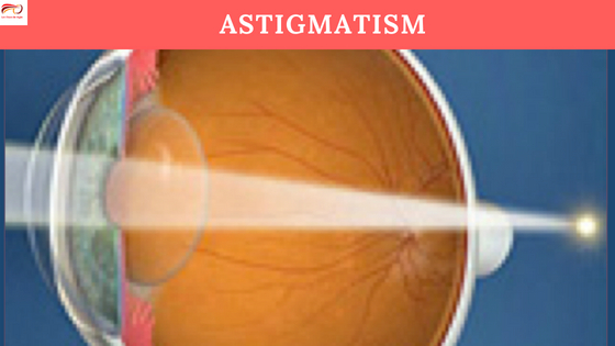 Nelivigi Eye Hospital in Bangalore: Astigmatism