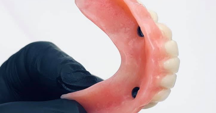 Single Tooth Dentures