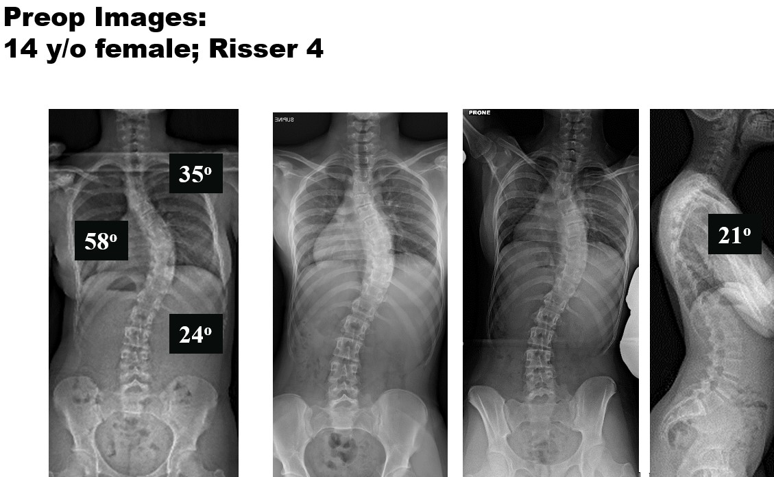 Spine Rotation in Scoliosis, Part 3 | Growing Spine Blog | Washington ...