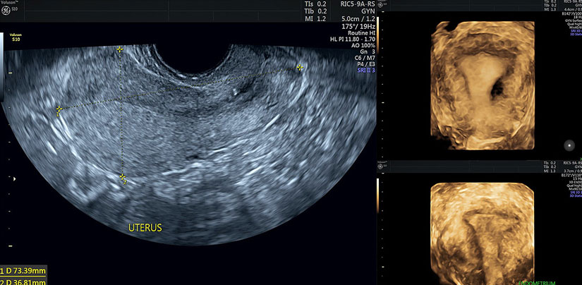 Trans-vaginal Gynaecology Ultrasound ( TVS ) - London Spectra