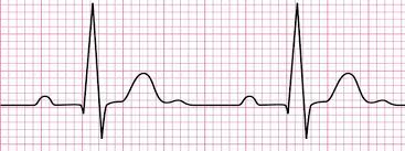 How does Electrocardiogram (ECG) work