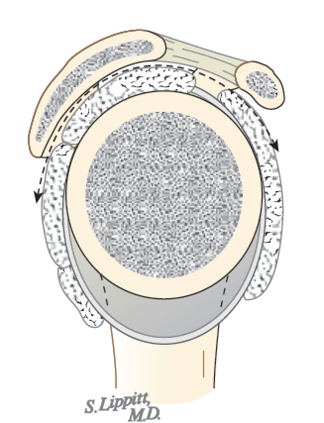 Shoulder Arthritis / Joint Replacement : Superior capsular ...