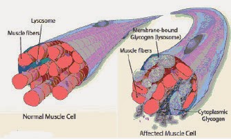 Medical Treatment Pictures-for Better Understanding: Pompe Disease