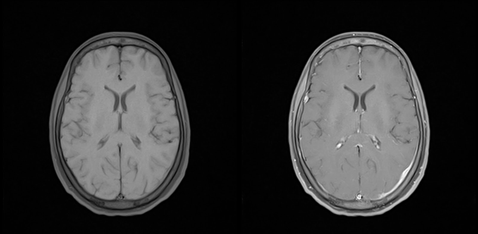 Ultimate Radiology : Hypertrophic Pachymeningitis