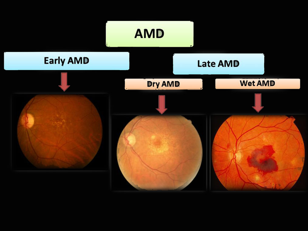 The Styrous® Viewfinder: (a droll) Macular degeneration